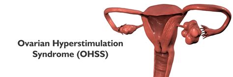 Ovarian Hyperstimulation Syndrome Ohss Symptoms And Causes