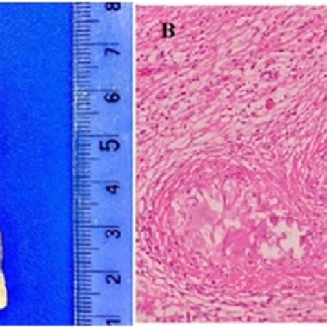 A Gross Picture Of The Inflamed Appendix Showing Luminal Obstruction Download Scientific