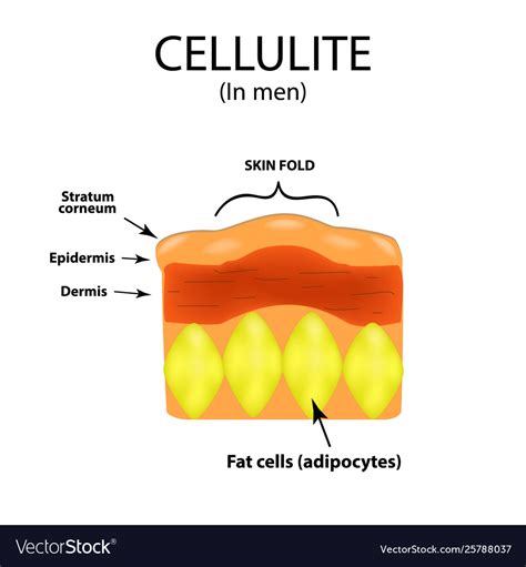 Cellulitis Skin Layer
