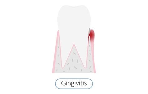Premium Vector Illustration By Stage Of Periodontal Disease Gingivitis