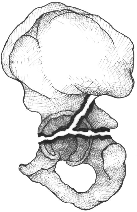 Classification Of Common Acetabular Fractures Radiographic And Ct