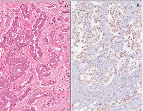 Figure 3 From Immunohistochemical Expression Of Wilms Tumor 1 Protein In Human Tissues From