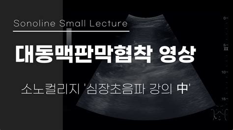 대동맥판막협착 초음파 영상 Ssl 7 Youtube