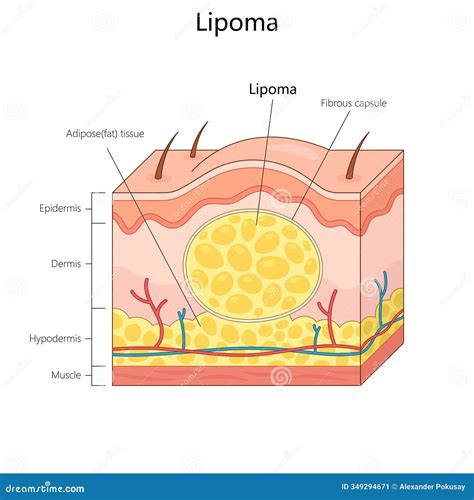 Illustration Of Lipoma In Skin Layers Medical Stock Vector