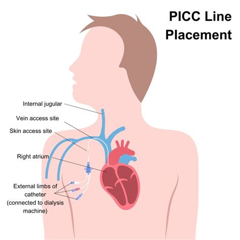 Port Or PICC Line Placement Vein Endovascular Medical Care