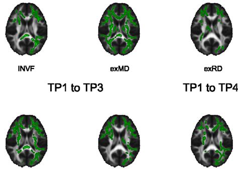 Significant Voxel Wise Group × Time Interaction Effects In Smt Metrics
