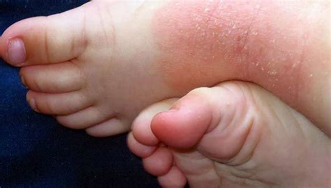 Psoriasis On Feet Symptoms Causes And Treatment