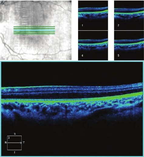 Spectral Domain Optical Coherence Tomography Showed An Absence Of Download Scientific Diagram