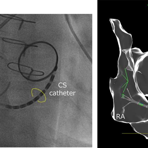 3d Mapping Image Of The Third Step Of The Cs Catheter Placement With