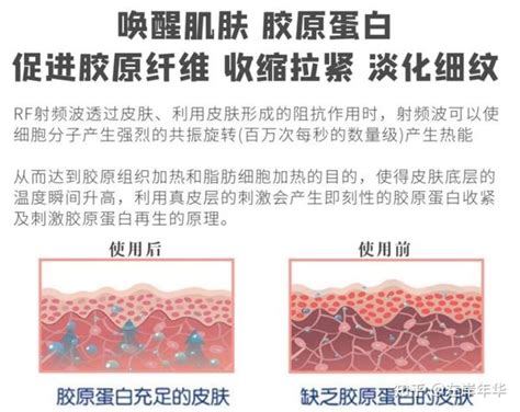 2021年家用射频美容仪原理有效性安全性及副作用全面解析 9月更新 知乎