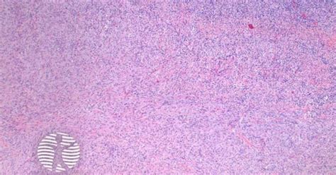 Leiomyosarcoma Pathology Image