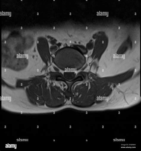 Axial Magnetic Resonance Imaging Mri Scan Of A Healthy Spine Stock