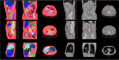 Addressing Medical Imaging Limitations With Synthetic Data Generation NVIDIA Technical Blog