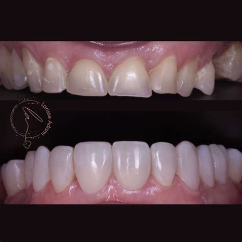Facetas De Resina Dra Larisse Adami