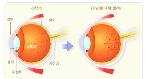 비문증 원인 눈앞 날파리 치료 방법