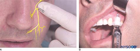 Local Anesthesia Infraorbital Nerve Block At Rory Barbour Blog