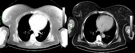 Beam Hardening Artefacts In A Large Patient Height 175 Cm Body Download Scientific Diagram