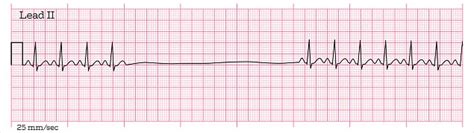 Sinus Arrest