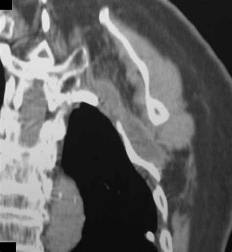 Scapulothoracic Bursitis Chronic At Becky Craig Blog