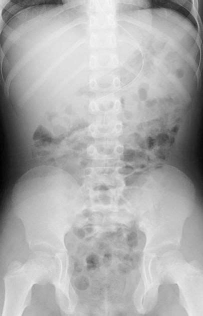Epispadias Buyxraysonline