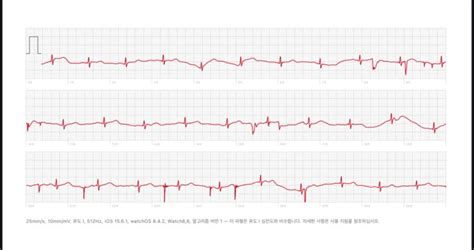 이 심전도 정상인가요 지식in