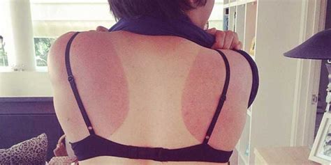 The Fastest Way To Get Rid Of A Sunburn Business Insider