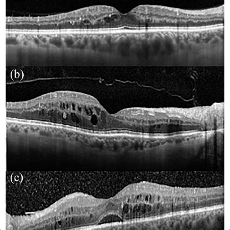 Severe Diabetic Maculopathy Download Scientific Diagram