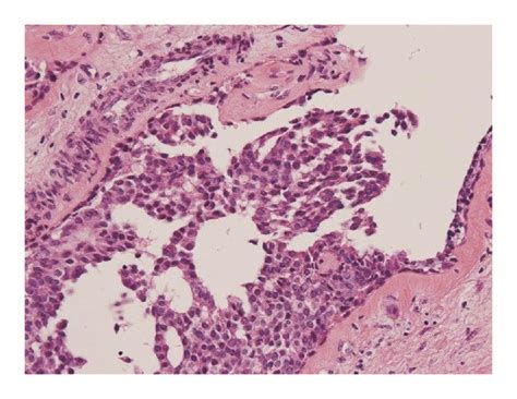 A The Tumor Cells Show A Solid Papillary Growth Pattern He Stain Download Scientific