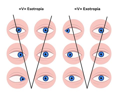 Premium Vector Types Of Strabismus V Esotropia And V Exotropia