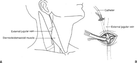Venous Access External And Internal Jugular Veins Basicmedical Key