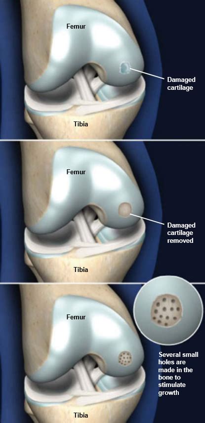 Microfracture Drilling Procedure For Isolated Chondral Defect Central