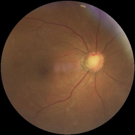 Classinternal Eye Roboflow Universe Search