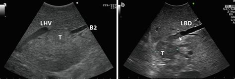 Parenchymal Sparing Liver Resections Abdominal Key