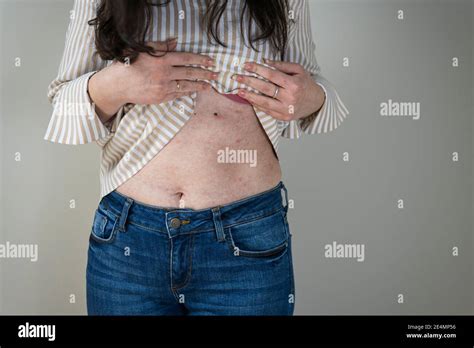 Women With Symptoms Of Itchy Urticaria Or Allergic Reaction On The Skin