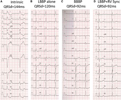 Bilateral Bundle Branch Area Pacing To Achieve Physiological Conduction System Activation