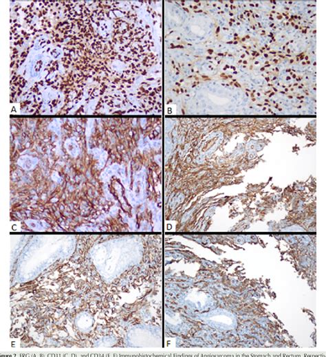 Figure 2 From Synchronous Double Primary Angiosarcoma Originating From