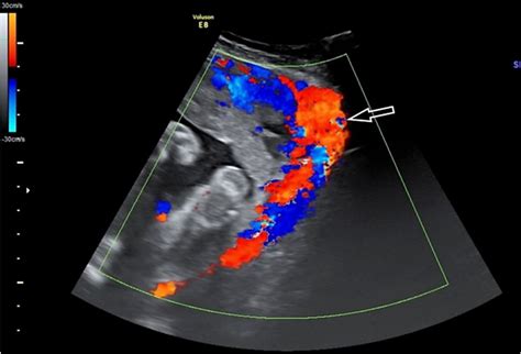 Transabdominal Sonogram Subplacental Hypervascularity White Arrow Download Scientific