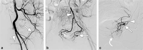 Rare Origin Of The Prostatic Artery From The Superior Rectal Artery