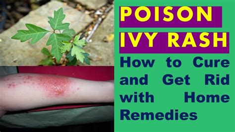 Poison Ivy Rash Rubbing Alcohol At Lan Lewis Blog