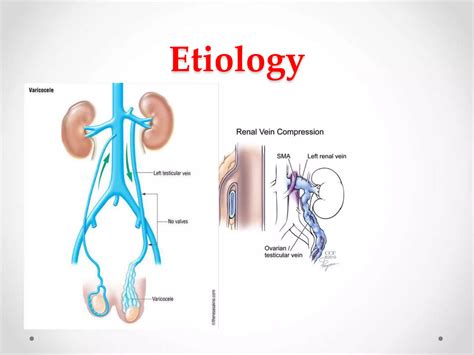 Varicocele And Infertilityppt