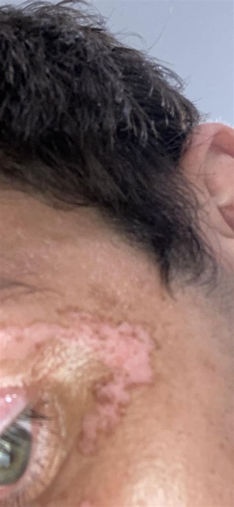 Repigmentation Progress Photos Rvitiligo