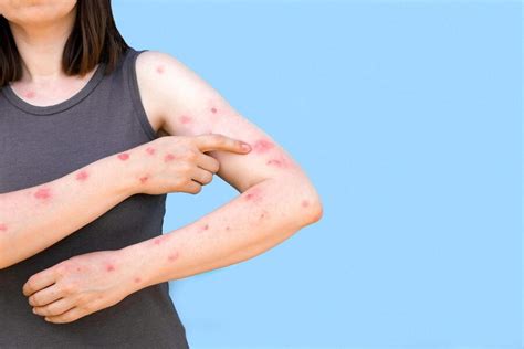Mpox Cases Doubles In Us Vaccination Crucial For High Risk Groups Cdc