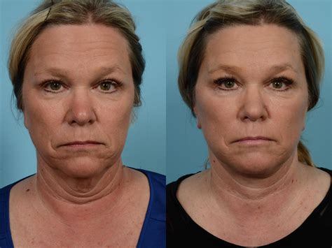 Facelift Before And After Photos Prove Just How Natural Todays Results