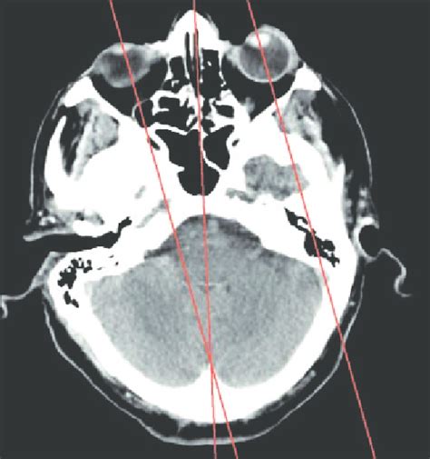 Ct Scan Showing Conjugate Eye Deviation To The Right The Patient Was