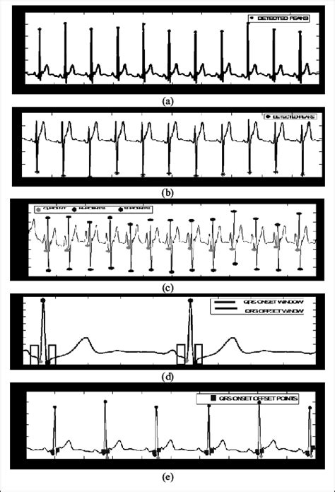 Detection Of Qrs Peaks And Qrs Onset And Offset A Detection Of R Peaks Download Scientific