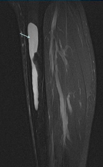 intraossäres Lipom der Tibia pacs