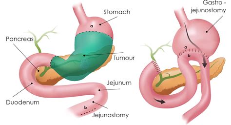 Gastric And Oesophageal Cancer Surgery Digestive Cancers Europe