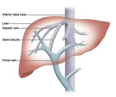 Understanding The Transjugular Intrahepatic Portosystemic Shunt Tips