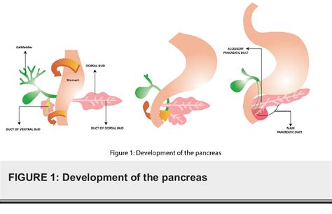 Figure 1 From Pancreatic Duct Variations And The Risk Of Post
