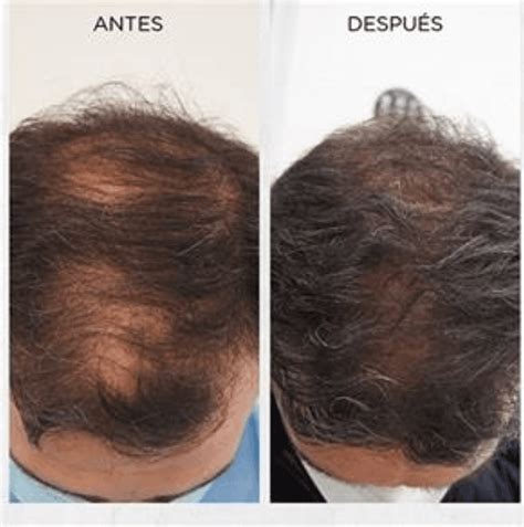 Qué es la tricología capilar | Man Medical Institute | Cirugía capilar